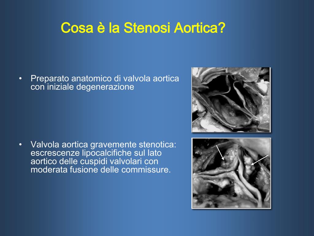 PPT - Dott. Pietro Bellone Dipartimento di Cardiologia ASL 2 Ospedale ...