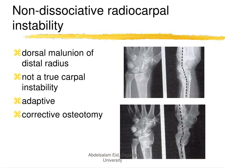 PPT - Carpal Instability: an overview PowerPoint Presentation - ID:4224170