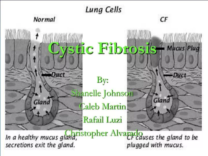 PPT - Cystic Fibrosis PowerPoint Presentation, free download - ID:4225742