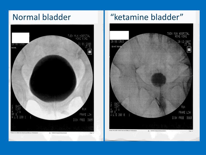 PPT - Lower Urinary Tract Symptoms (includes ketamine cystitis ...