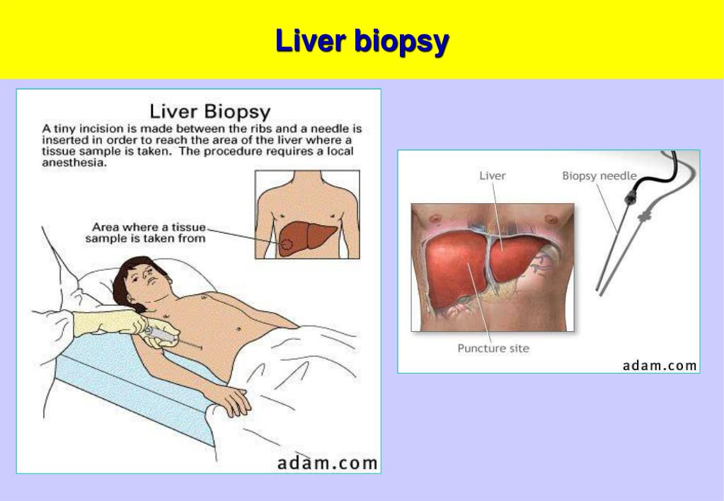 Liver Biopsy Procedure