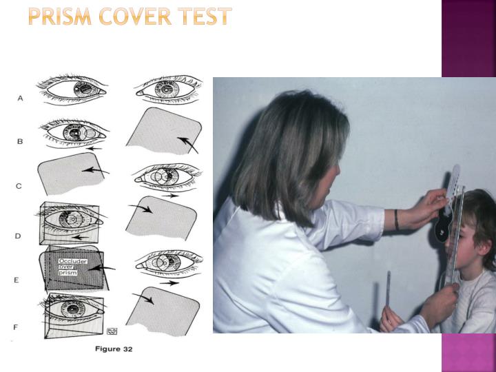 PPT - STRABISMUS PowerPoint Presentation - ID:4244910