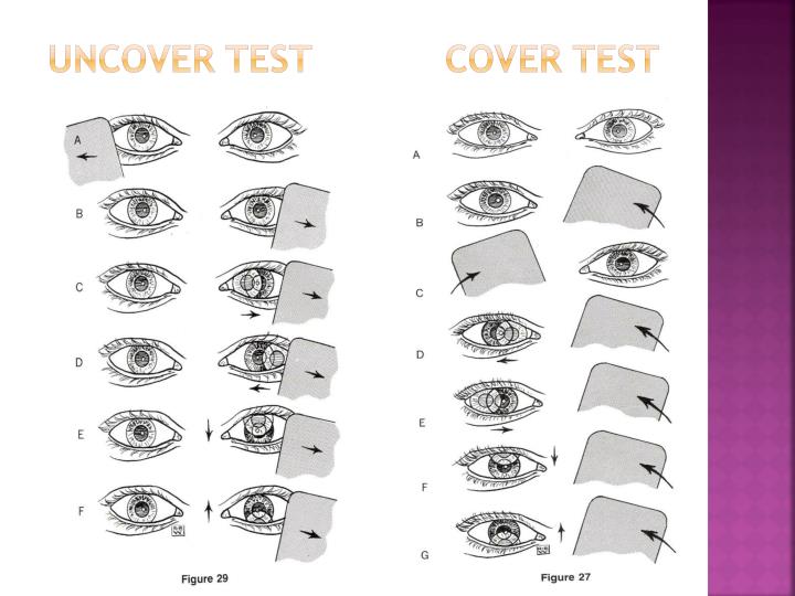 PPT - STRABISMUS PowerPoint Presentation - ID:4244910