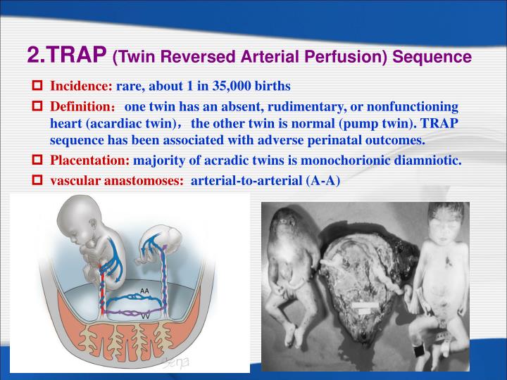 PPT - Multifetal Gestation PowerPoint Presentation - ID:4253350