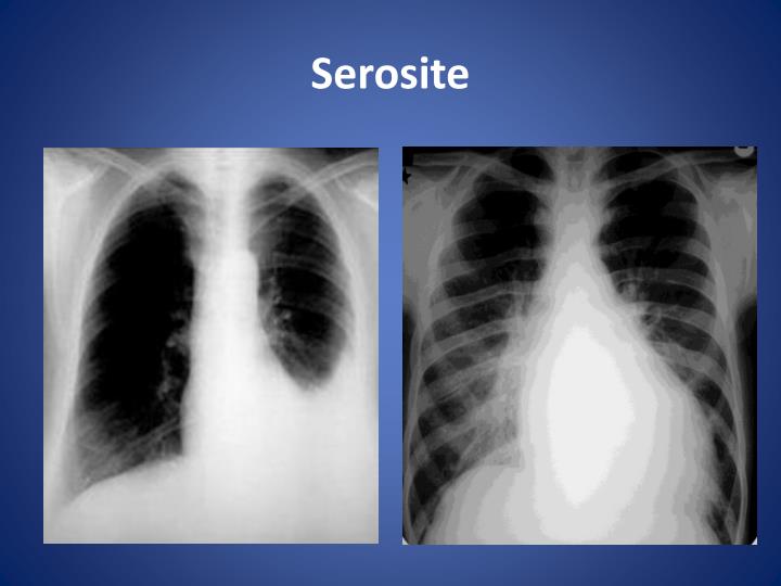 PPT - Lúpus Eritematoso Sistêmico (LES) PowerPoint Presentation - ID ...