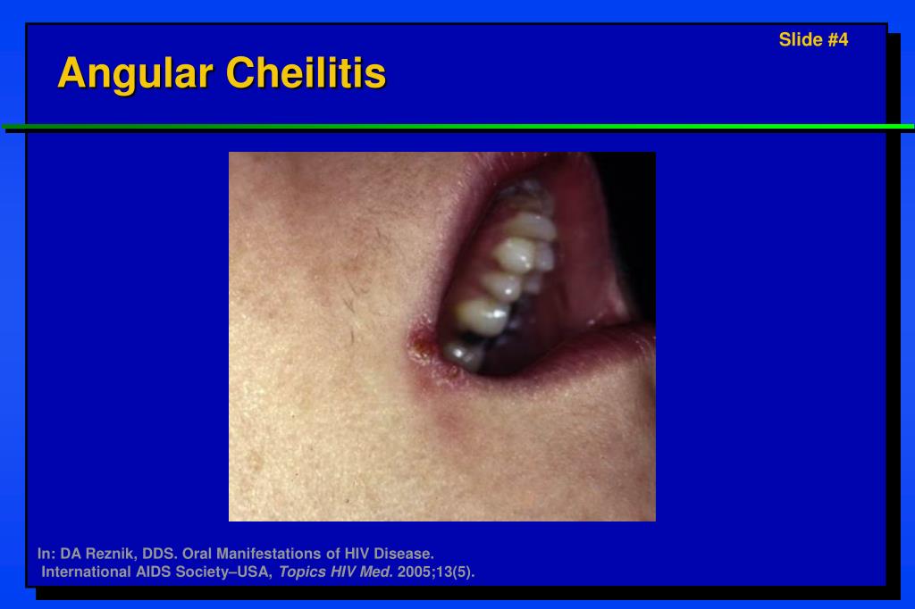 Angular Cheilitis Hiv