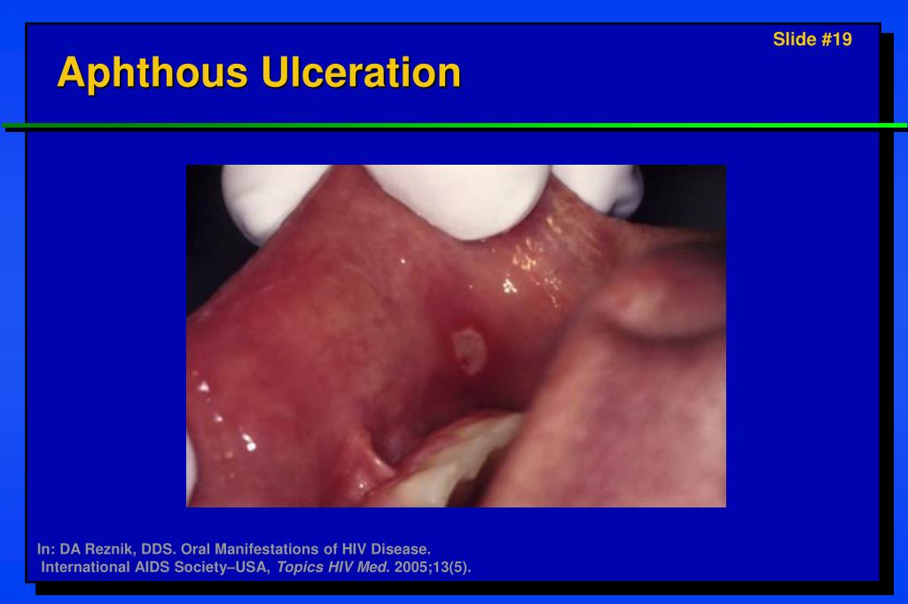 PPT - Oral Manifestations of HIV Disease PowerPoint Presentation, free ...