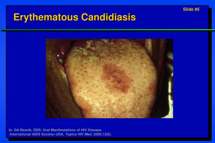 PPT - Oral Manifestations of HIV Disease PowerPoint Presentation - ID ...