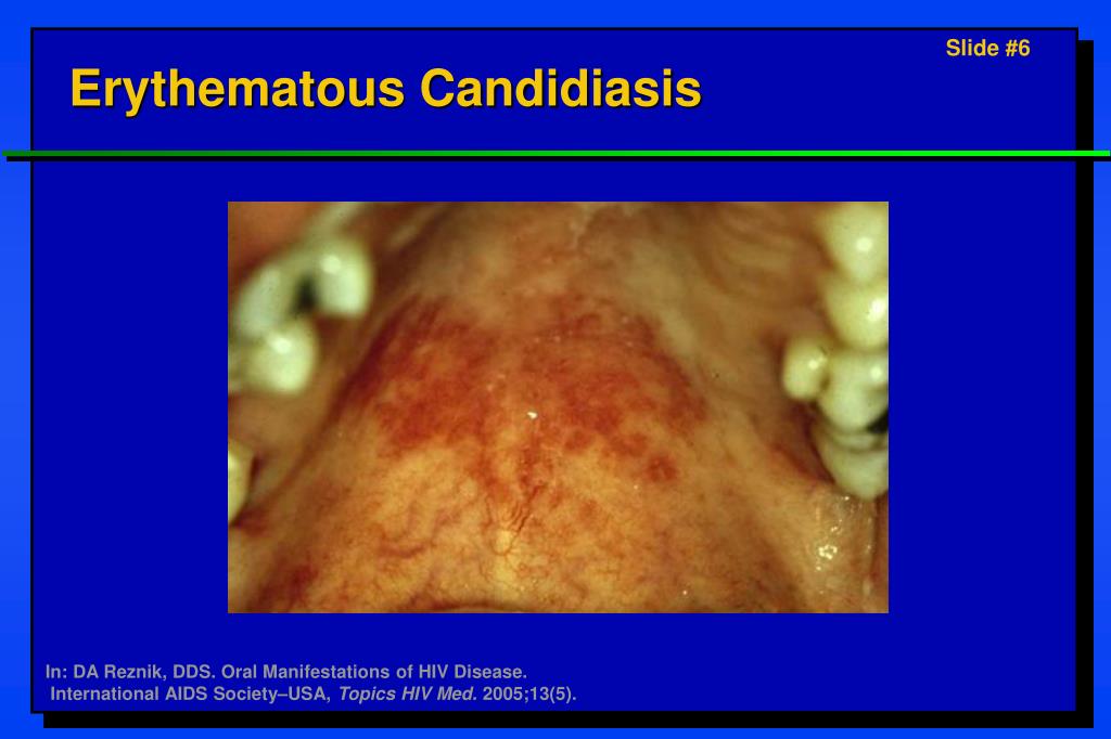 PPT - Oral Manifestations of HIV Disease PowerPoint Presentation, free ...