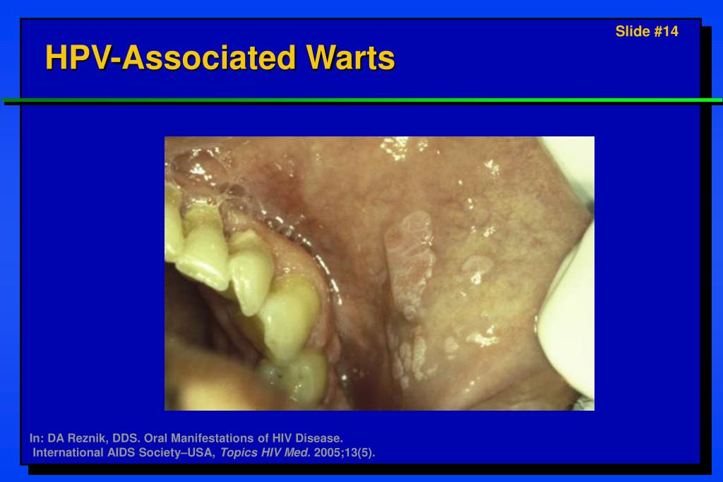 PPT - Oral Manifestations of HIV Disease PowerPoint Presentation, free ...