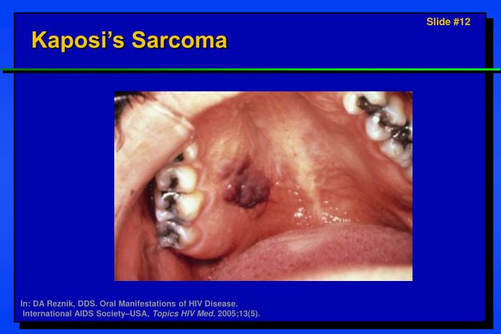 PPT - Oral Manifestations of HIV Disease PowerPoint Presentation - ID ...