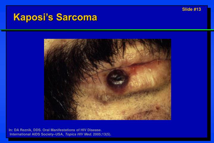 PPT - Oral Manifestations of HIV Disease PowerPoint Presentation - ID ...