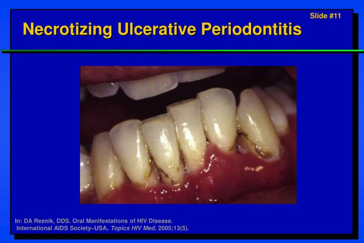 Necrotizing Ulcerative Gingivitis Before And After