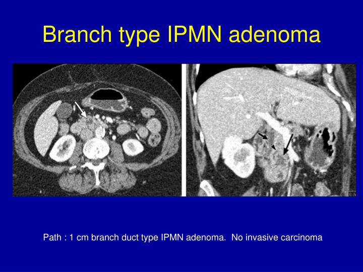 PPT - Intraductal Papillary Mucinous Neoplasms PowerPoint Presentation ...