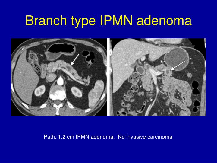 PPT - Intraductal Papillary Mucinous Neoplasms PowerPoint Presentation ...