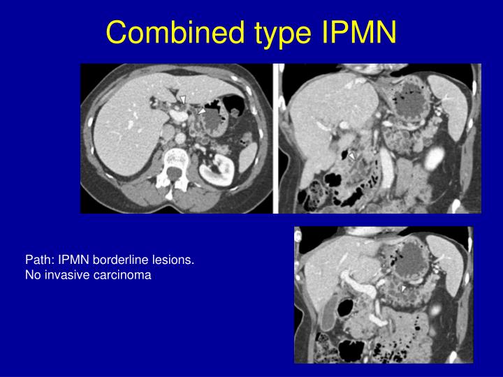 PPT - Intraductal Papillary Mucinous Neoplasms PowerPoint Presentation ...