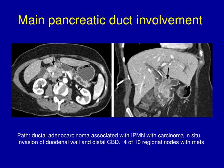 PPT - Intraductal Papillary Mucinous Neoplasms PowerPoint Presentation ...