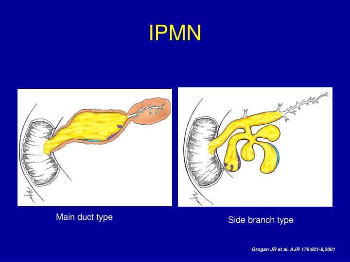 PPT - Intraductal Papillary Mucinous Neoplasms PowerPoint Presentation ...
