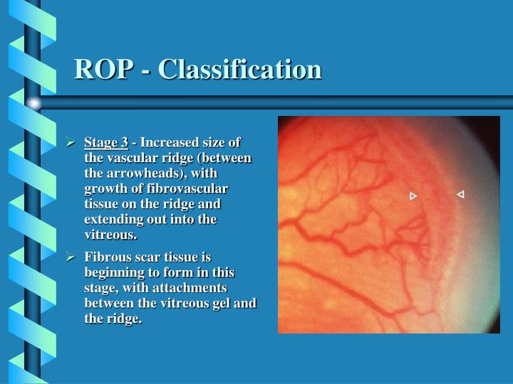 PPT - Retinopathy Of Prematurity PowerPoint Presentation - ID:4273995