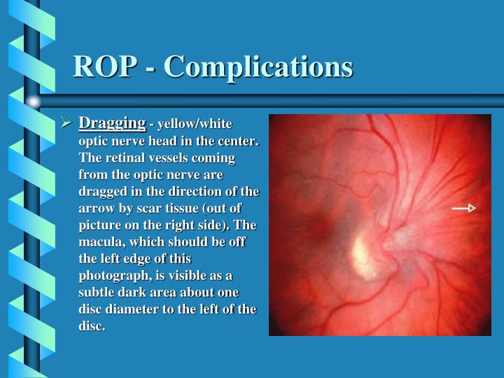 PPT - Retinopathy Of Prematurity PowerPoint Presentation - ID:4273995