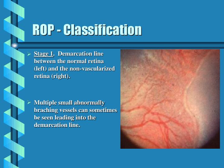 PPT - Retinopathy Of Prematurity PowerPoint Presentation - ID:4273995