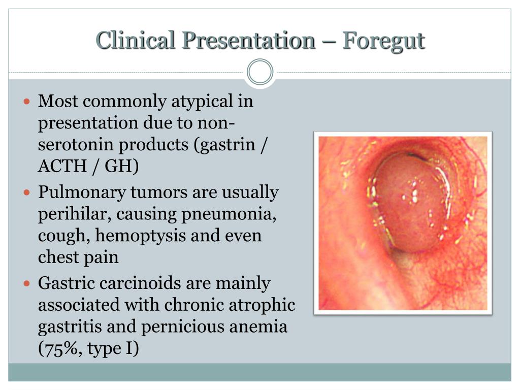 PPT - Diagnosis & Surgical Management of Carcinoid Tumors PowerPoint ...