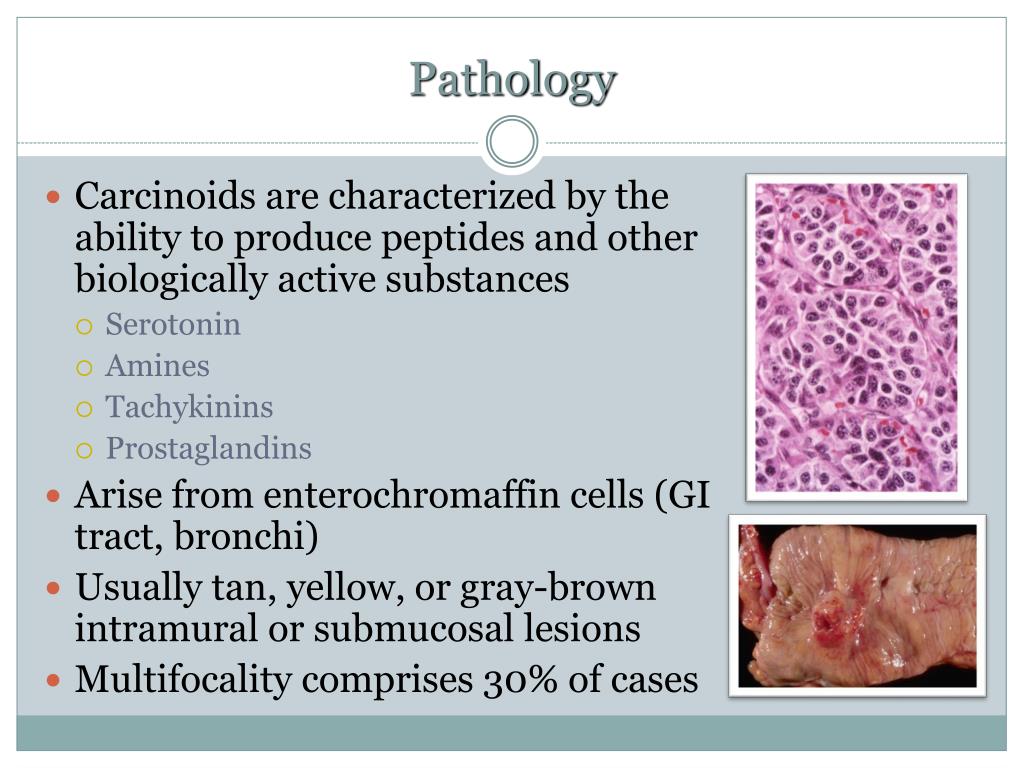 PPT - Diagnosis & Surgical Management of Carcinoid Tumors PowerPoint ...