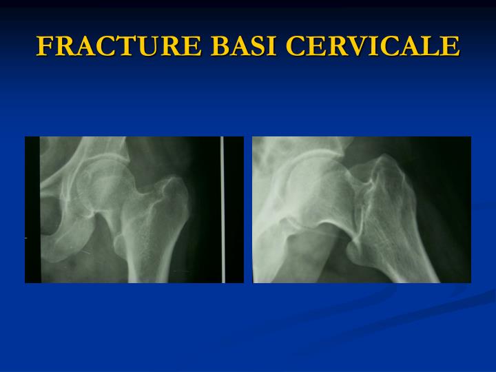 PPT - FRACTURES DE L’EXTREMITE SUPERIEURE DU FEMUR PowerPoint ...