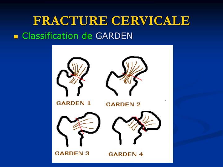 PPT - FRACTURES DE L’EXTREMITE SUPERIEURE DU FEMUR PowerPoint ...