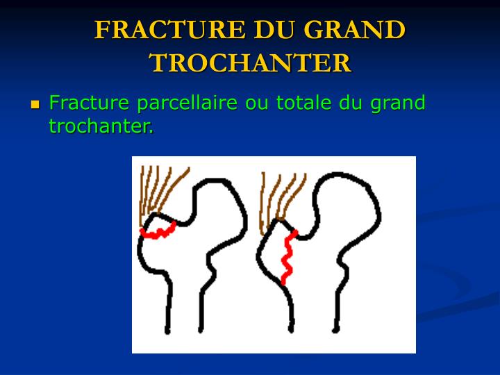 PPT - FRACTURES DE L’EXTREMITE SUPERIEURE DU FEMUR PowerPoint ...