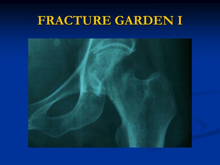 PPT - FRACTURES DE L’EXTREMITE SUPERIEURE DU FEMUR PowerPoint ...