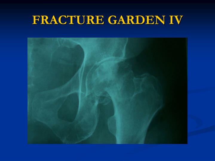 PPT - FRACTURES DE L’EXTREMITE SUPERIEURE DU FEMUR PowerPoint ...