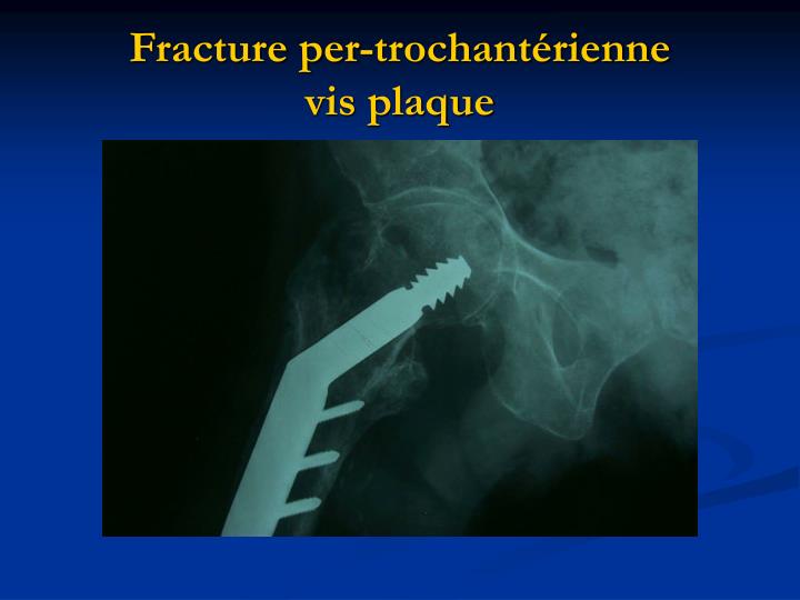 PPT - FRACTURES DE L’EXTREMITE SUPERIEURE DU FEMUR PowerPoint ...