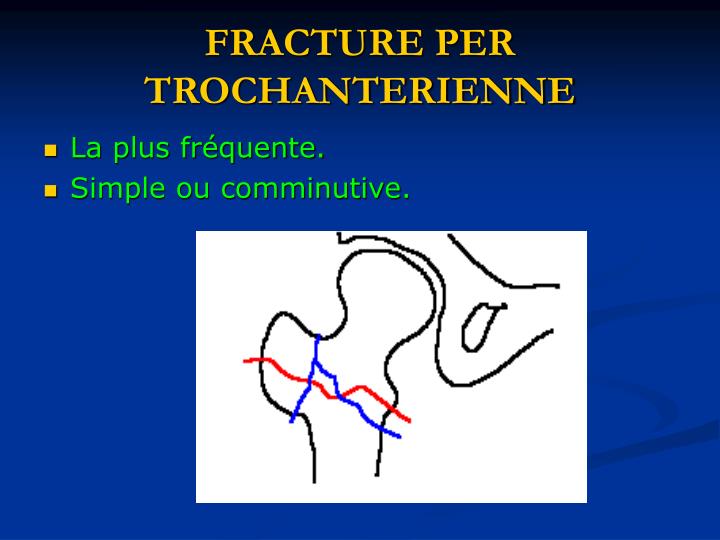 PPT - FRACTURES DE L’EXTREMITE SUPERIEURE DU FEMUR PowerPoint ...