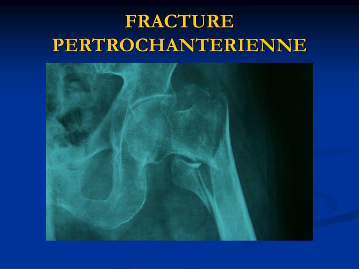 PPT - FRACTURES DE L’EXTREMITE SUPERIEURE DU FEMUR PowerPoint ...