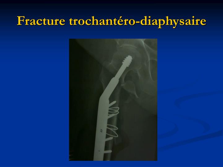 PPT - FRACTURES DE L’EXTREMITE SUPERIEURE DU FEMUR PowerPoint ...