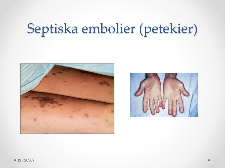 PPT - CNS-infektioner Meningit och encefalit PowerPoint Presentation ...