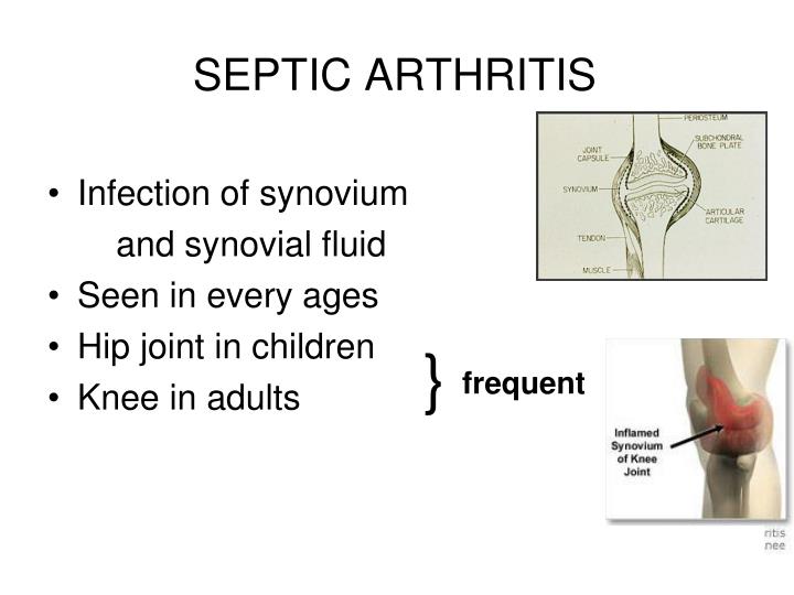 PPT - Septic arthritis Reşat ÖZARAS, MD, Prof. Infection Dept. rozaras ...