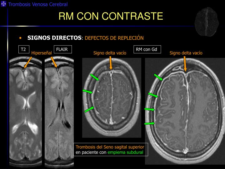 PPT - TROMBOSIS VENOSA CEREBRAL “ Lo que el radiólogo general debe ...