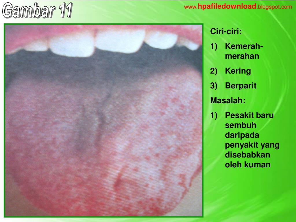 PPT - DIAGNOSA LIDAH PowerPoint Presentation, free download - ID:4295697 PPT - DIAGNOSA LIDAH PowerPoint Presentation, free download - ID:4295697