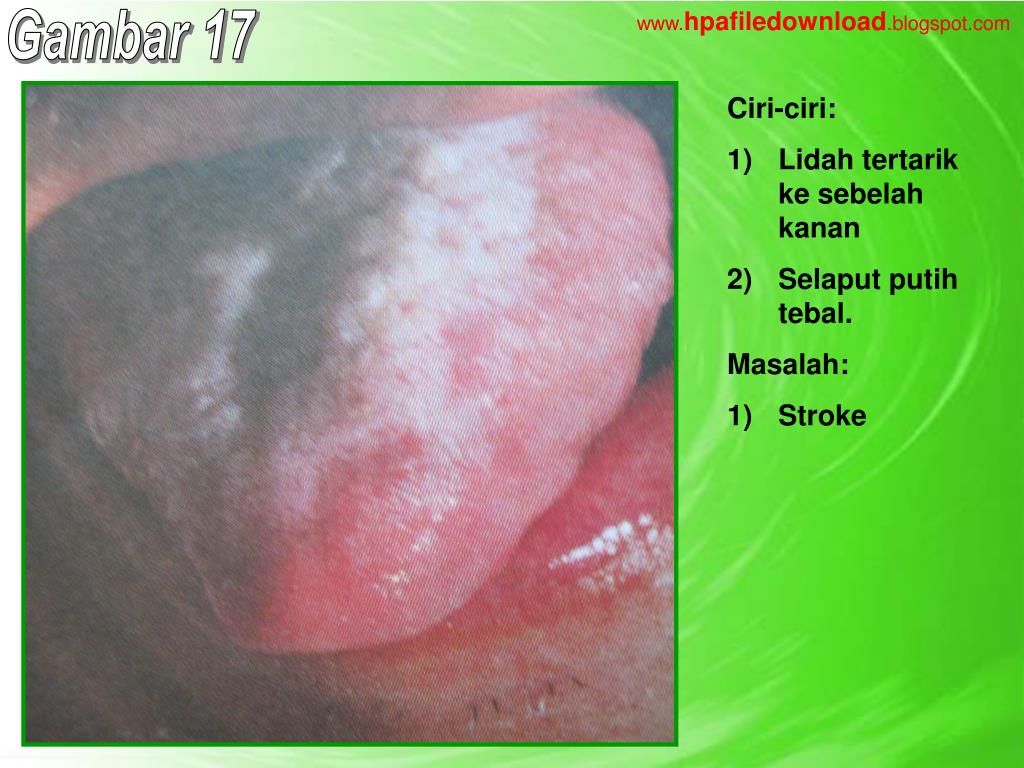 PPT - DIAGNOSA LIDAH PowerPoint Presentation, free download - ID:4295697 PPT - DIAGNOSA LIDAH PowerPoint Presentation, free download - ID:4295697