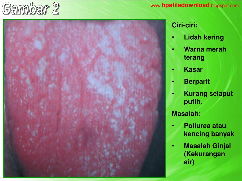 PPT - DIAGNOSA LIDAH PowerPoint Presentation, free download - ID:4295697 PPT - DIAGNOSA LIDAH PowerPoint Presentation, free download - ID:4295697