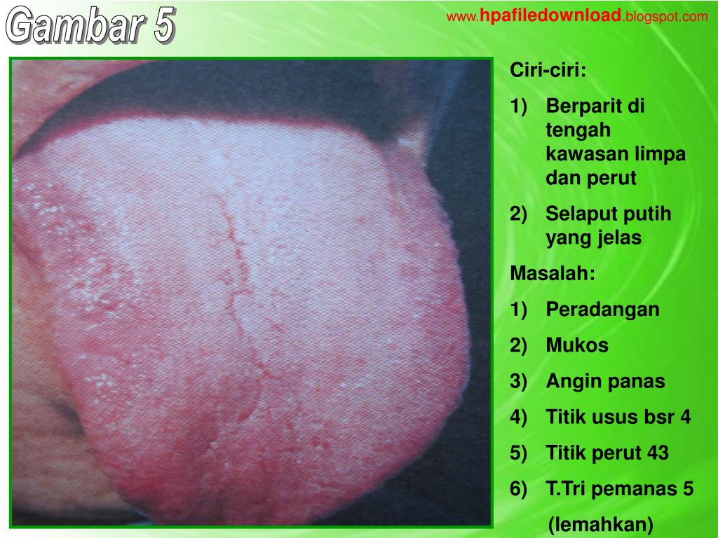 PPT - DIAGNOSA LIDAH PowerPoint Presentation, free download - ID:4295697 PPT - DIAGNOSA LIDAH PowerPoint Presentation, free download - ID:4295697