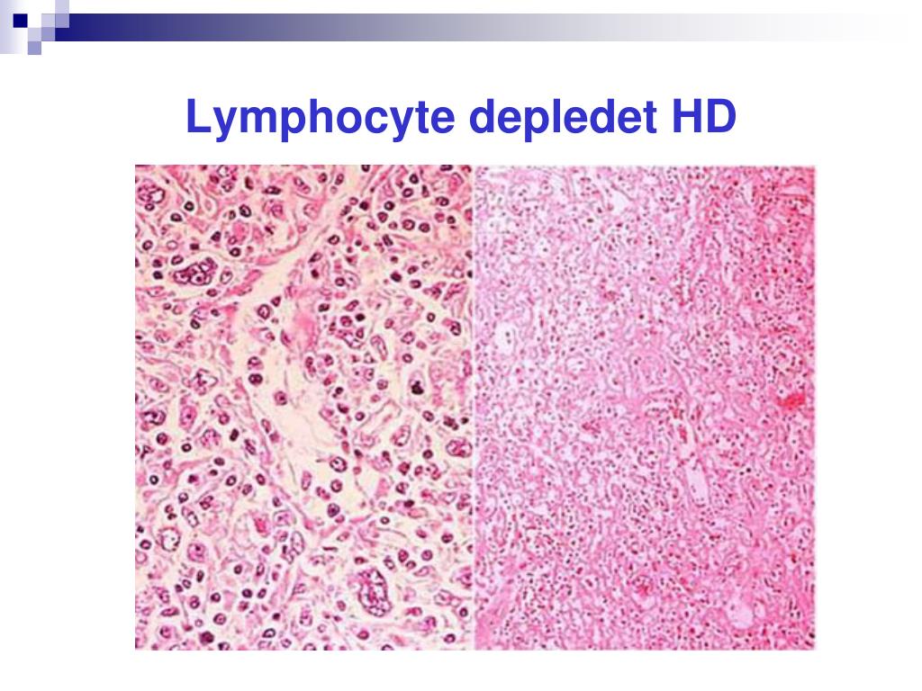 PPT - Hodgkin’s Lymphoma or Disease (HD) PowerPoint Presentation, free ...
