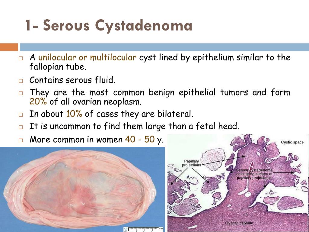 Ppt Ovarian Cyst Dr Hatem Al Nuaimi Consultant Pathologist Mb Ch B
