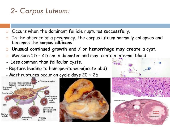 PPT - Ovarian cyst Dr. Hatem Al- Nuaimi Consultant pathologist MB.Ch.B ...