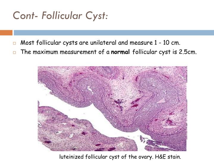 PPT - Ovarian cyst Dr. Hatem Al- Nuaimi Consultant pathologist MB.Ch.B ...