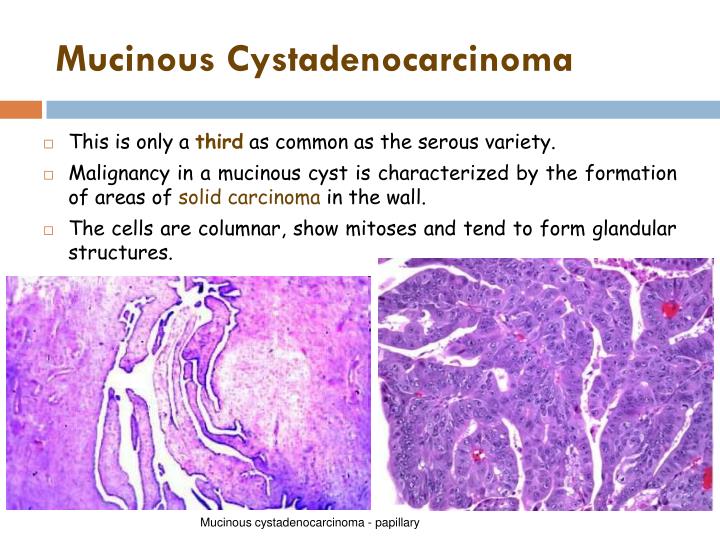 PPT - Ovarian cyst Dr. Hatem Al- Nuaimi Consultant pathologist MB.Ch.B ...