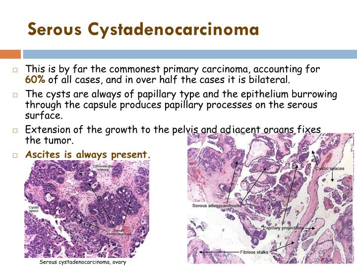 PPT - Ovarian cyst Dr. Hatem Al- Nuaimi Consultant pathologist MB.Ch.B ...