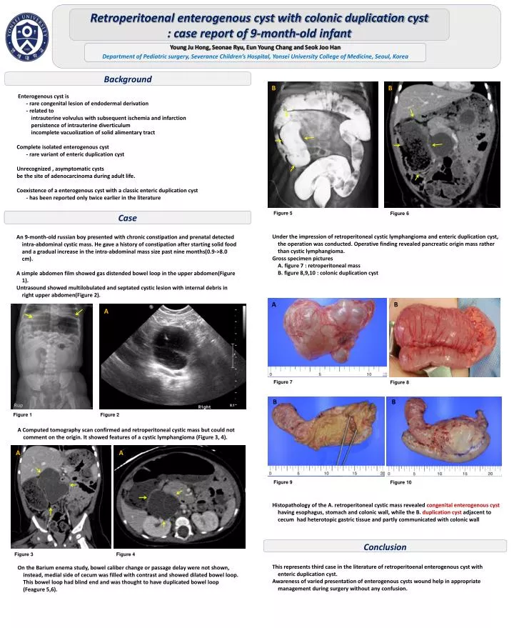 PPT - Retroperitoenal enterogenous cyst with colonic duplication cyst ...